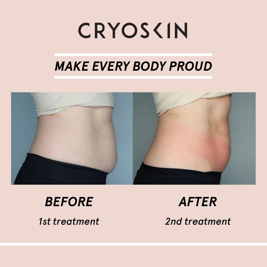 Cryoskin Before & After Photos - Body Contouring Academy